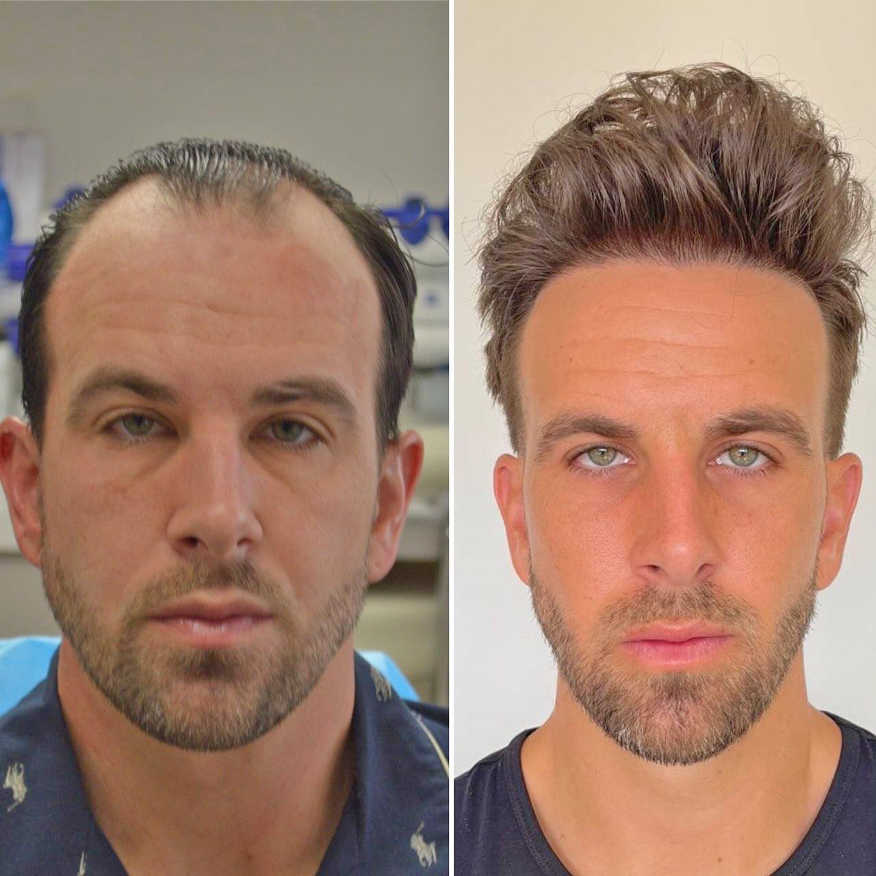 Hair Transplant Before And After Pictures Inspiring Transformations Hair Transplant Before And After Pictures Inspiring Transformations